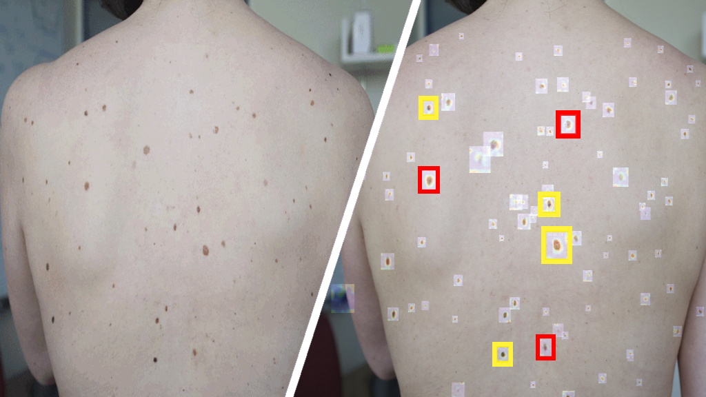 An Artificial Intelligence Tool Can Help Detect Suspicious Skin Lesions ...