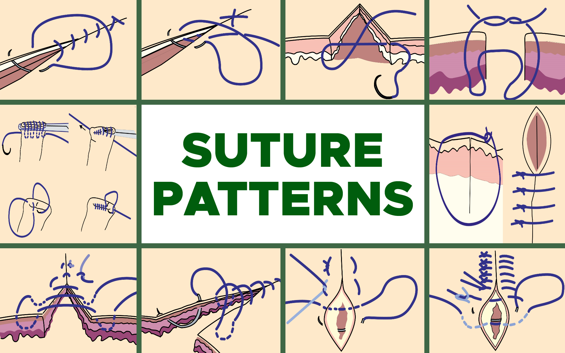 Common Suture Patterns And Suture Techniques EndoGynecology
