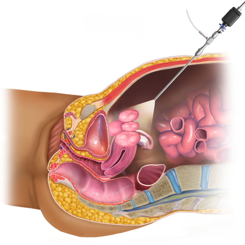 Laparoscopic Myomectomy - EndoGynecology